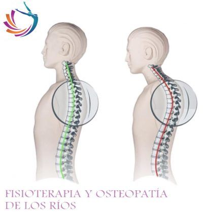 Cifosis – Fisioterapia de los Ríos