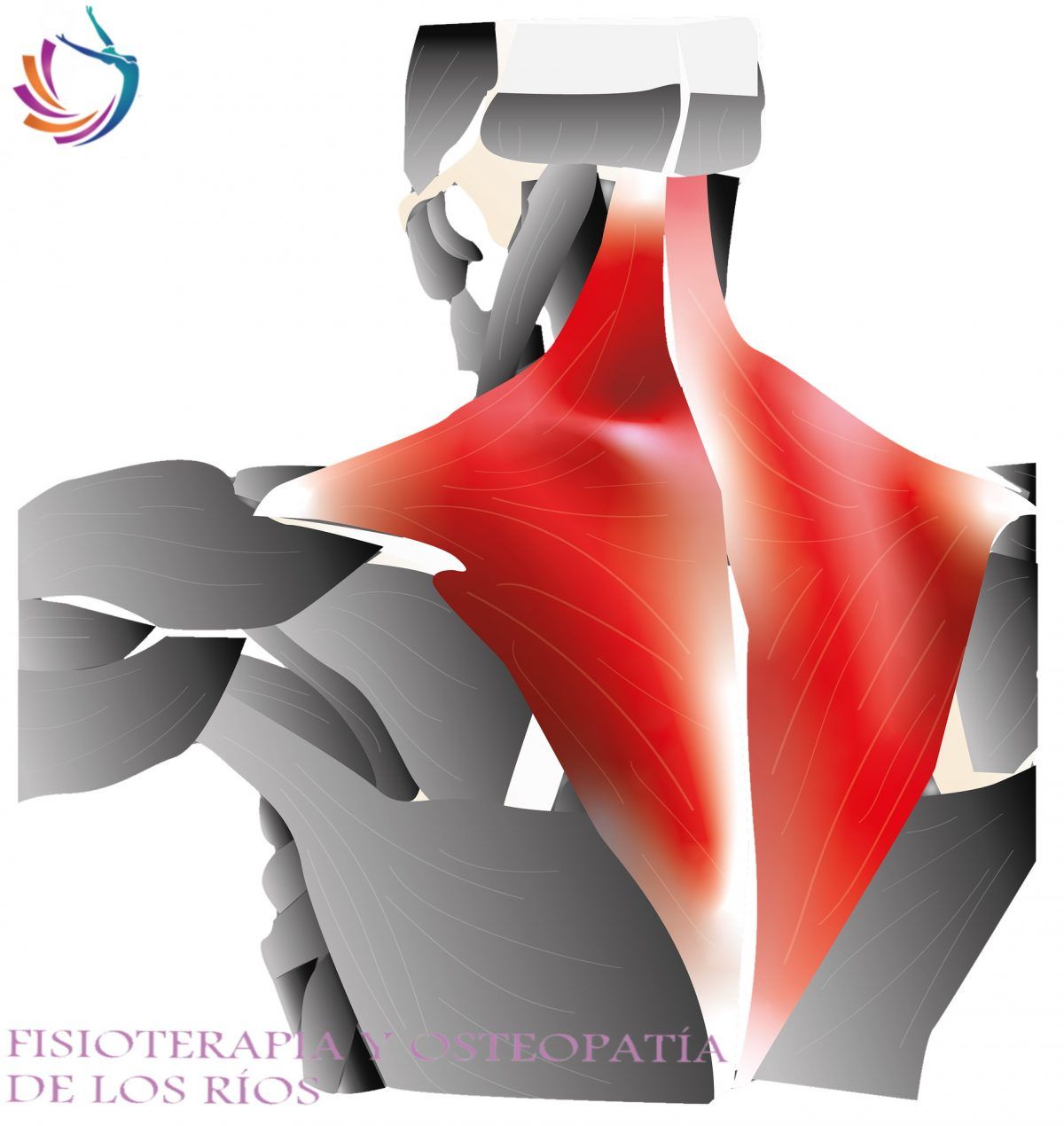 Contractura del trapecio – Fisioterapia de los Ríos